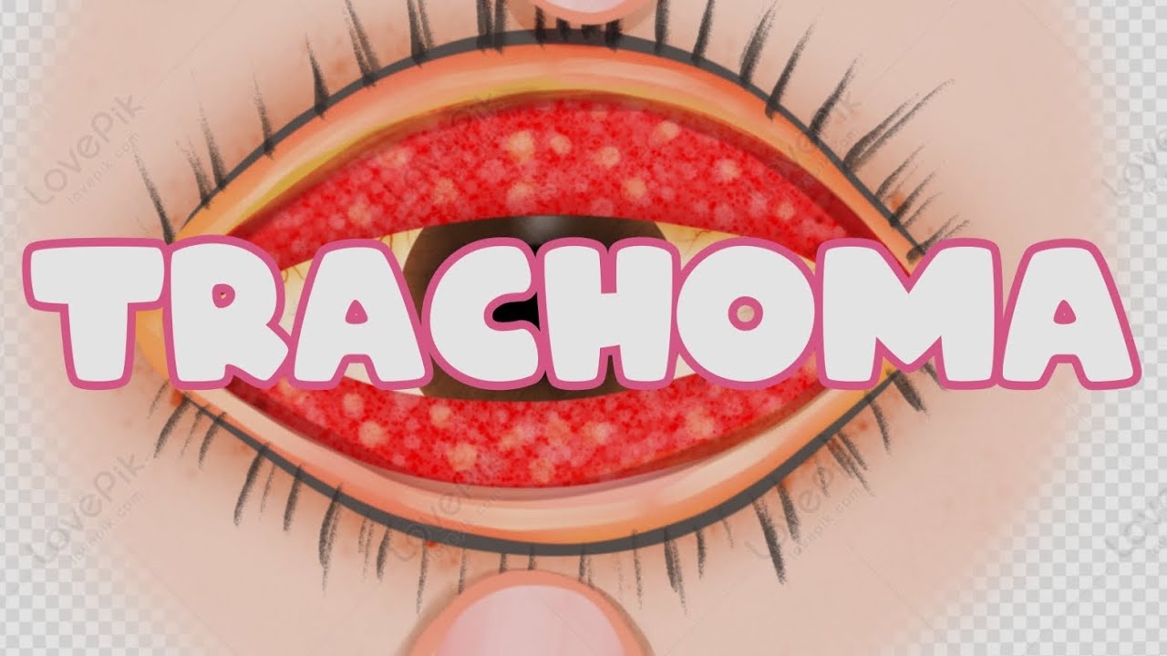 Trachoma | Etiology | clinical Features | stages | Management - YouTube