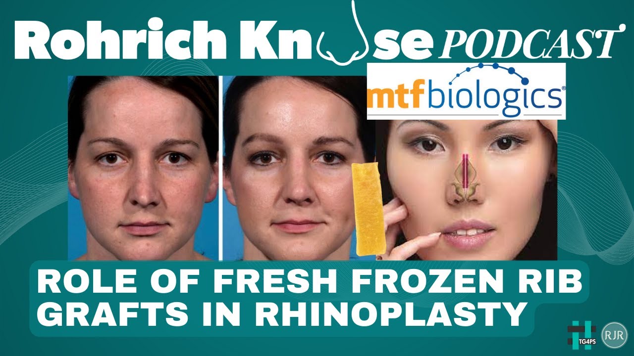 Role of Fresh Frozen Rib Grafts in Rhinoplasty - YouTube
