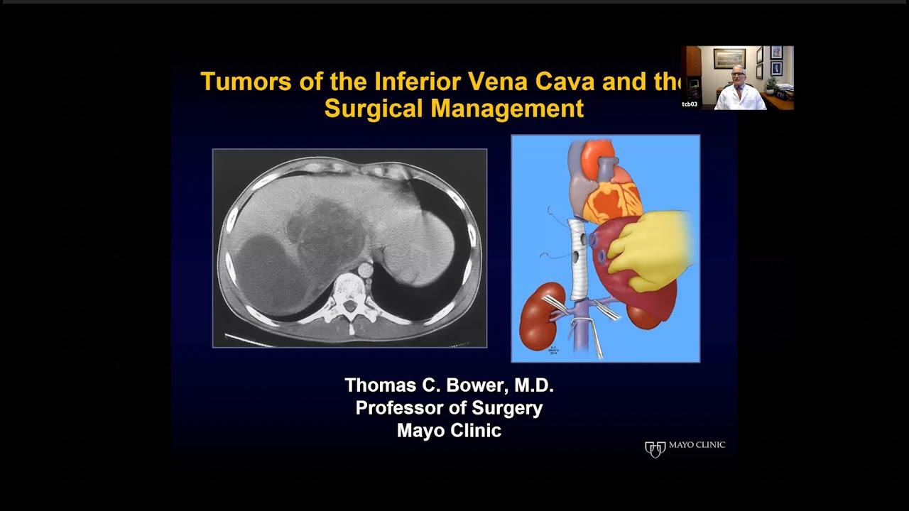 Tumors of the Inferior Vena Cava and their Surgical Management - YouTube