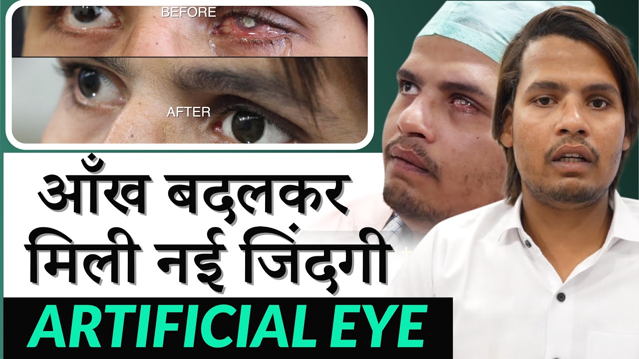 नकली आँख से मिली नई जिंदगी | Artificial Eye | Prosthetic Eye ...