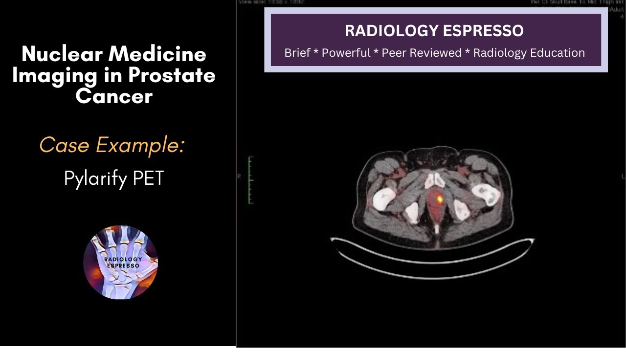 NUCLEAR MEDICINE IMAGING IN PROSTATE CANCER: Case Example – Pylarify ...