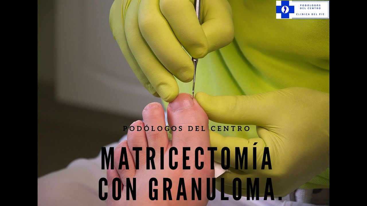 Matricectomía con granuloma 18-02-2025 - YouTube