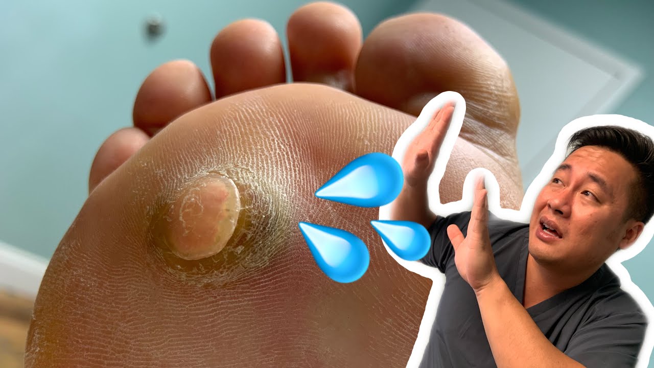 Wart Pops into Doctor's Face! - YouTube