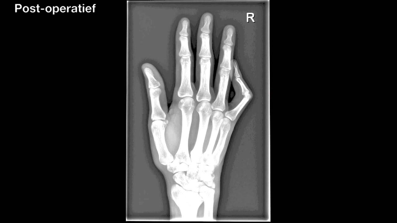 Splijtingsfractuur Os Hamatum - YouTube