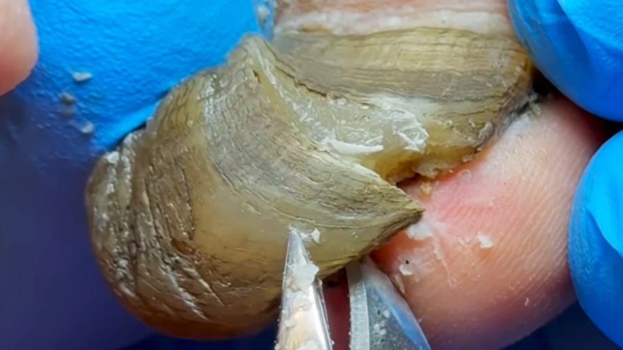 Dark Green Toenails With Mud Inside, Professionally Trimmed【Podiatry ...