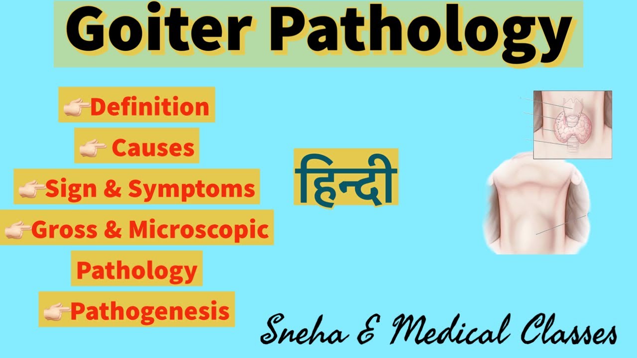 Goiter Hindi Pathogenesis Gross Microscopic Pathology goiter-hindi-pathogenesis-gross-microscopic-pathology