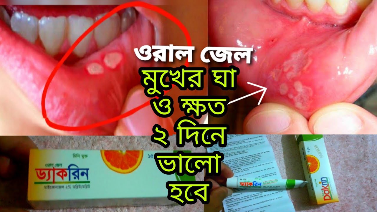 Dakrin Oral Gel | Micoral Gel | Mouth Infection | মুখের খত ভালো করার ...