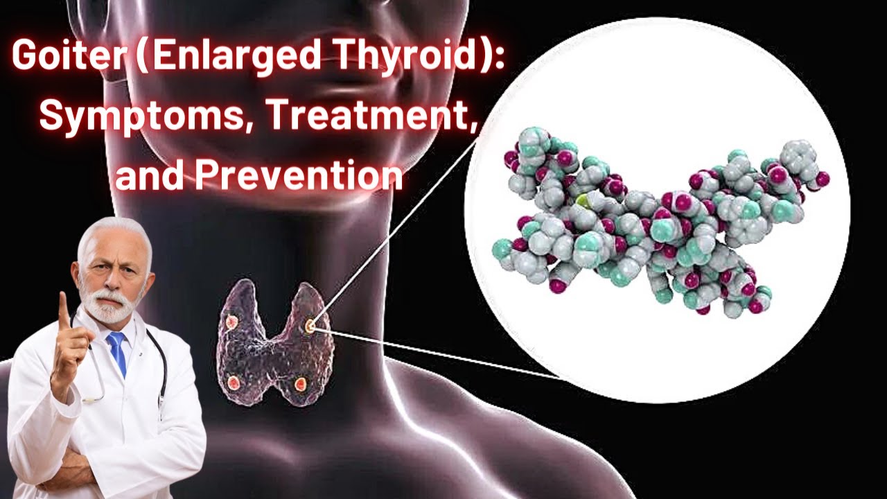 Goiter Enlarged Thyroid Symptoms, Treatment, and Prevention - YouTube