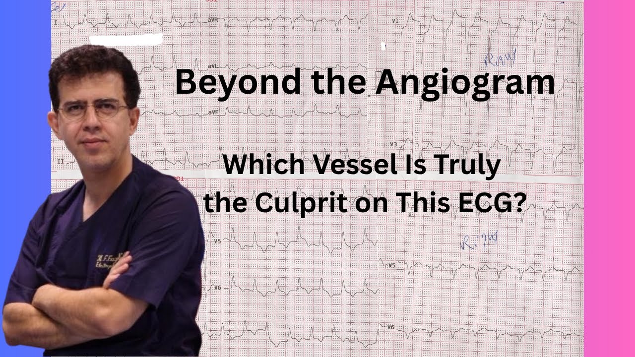 29: Beyond the Angiogram: Which Vessel Is Truly the Culprit on This ECG ...