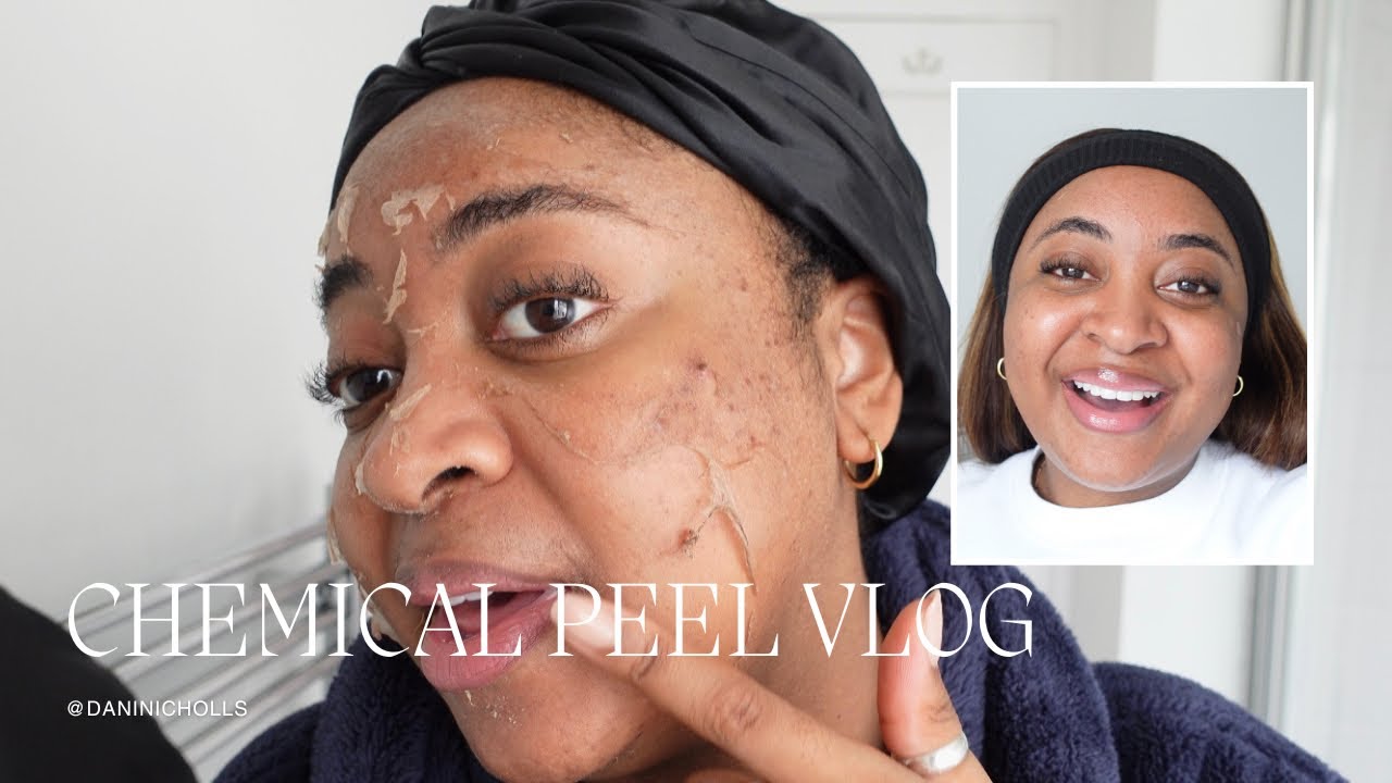 CHEMICAL PEEL FULL PROCESS 🐍 BEFORE & AFTER |HYPERPIGMENTATION / ACNE ...