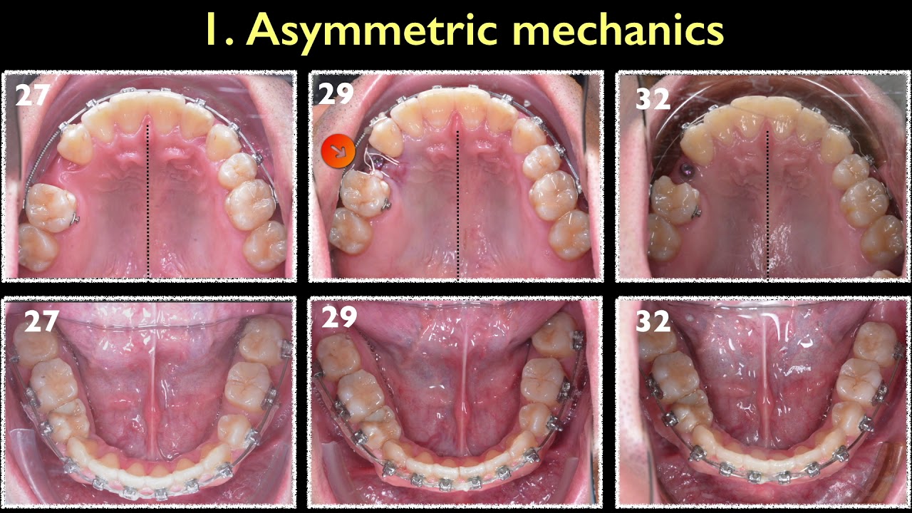 Correction of Collapsed Class lll Malocclusion and Dentofacial ...