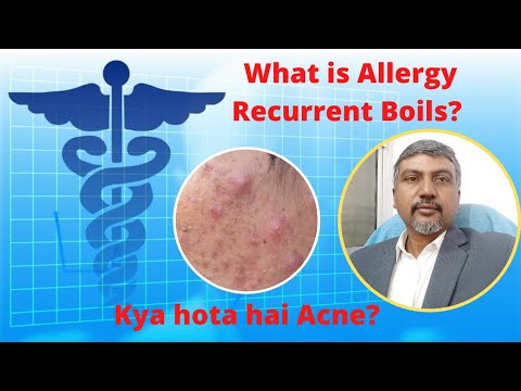 What is Acne? | Allergy recurrent boils - YouTube