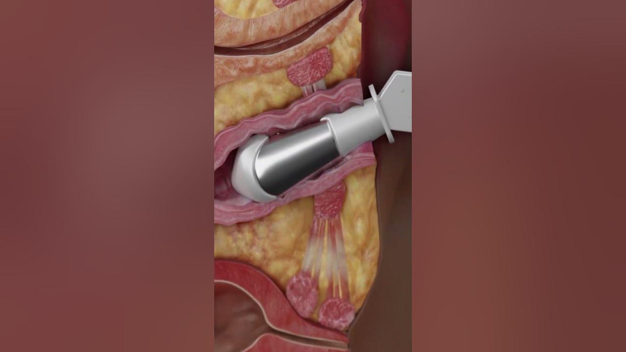 VTone: Non-Invasive Pelvic Floor Strengthening for Women’s Wellness - YouTube