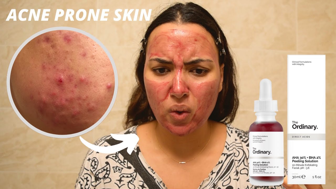 FIRST TIME USING THE ORDINARY AHA 30% + BHA 2% PEELING SOLUTION How to ...