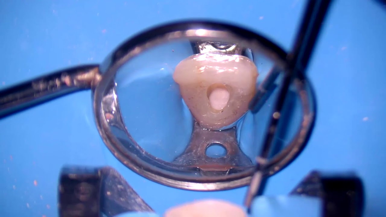 Endo bleaching protocol - YouTube