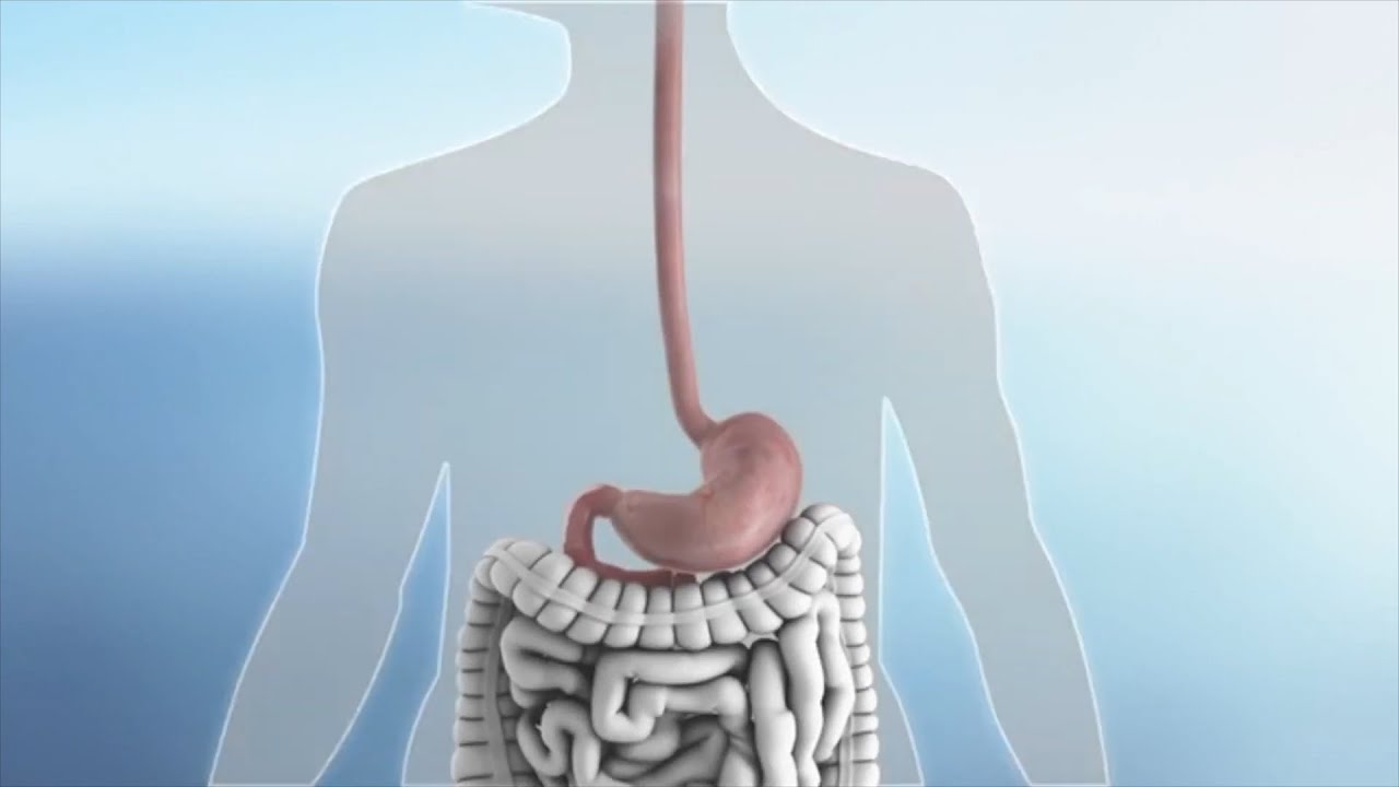 Sleeve Revision Animation, Grand Strand Bariatric Surgery - YouTube