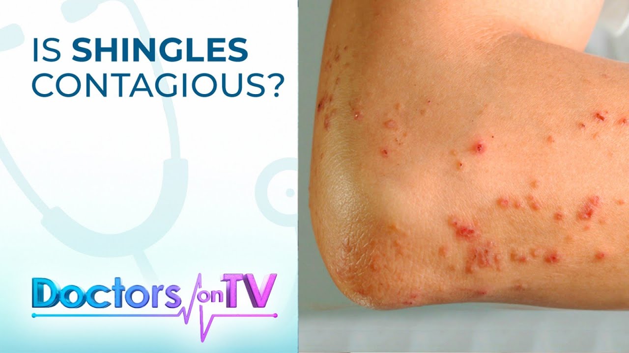 Shingles Symptoms Causes Prevention And Treatment Act - vrogue.co