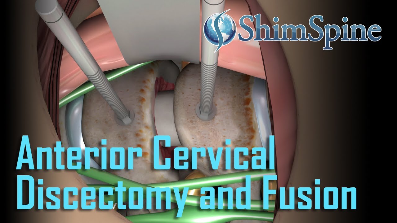 Cervical Discectomy And Fusion