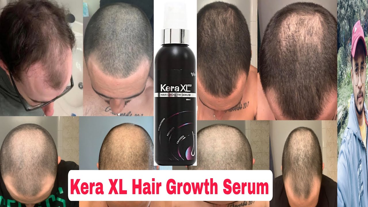 Kera XL Hair Growth Serum Review - YouTube