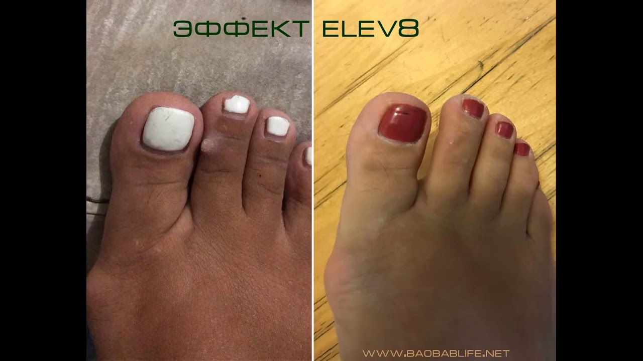 действие ELEV8 и ACCELER8 на кожные заболевания людей - YouTube