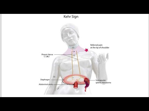 Kehr's Sign in Splenic Rupture or Spleen Abscess ; Definition, Meaning, Procedure to elicit ...