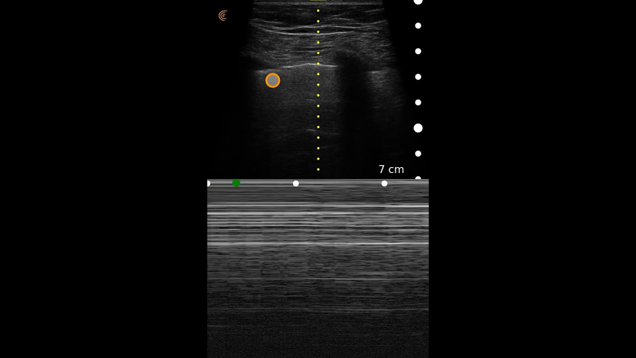 Picture Of Pneumothorax M Mode Ultrasound