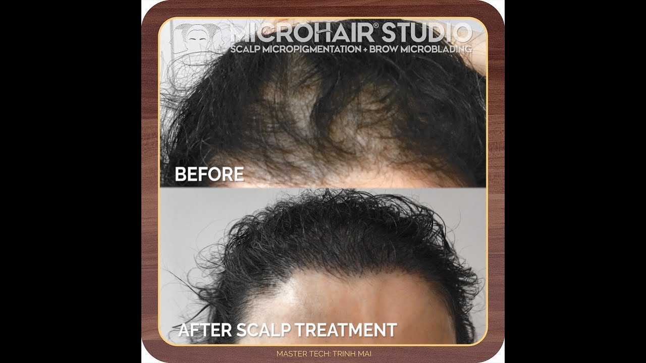 MICROHAIR STUDIO: SCALP MICROPIGMENTATION (combined with hair ...