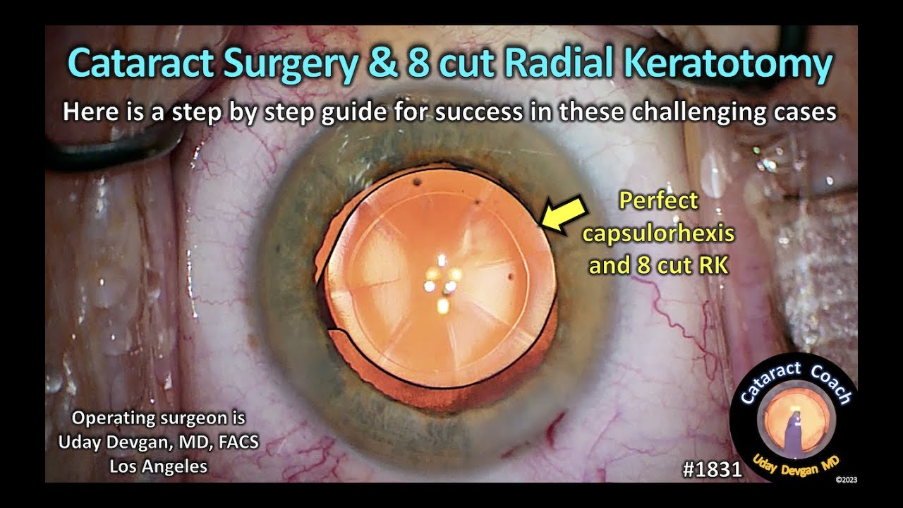 CataractCoach™1831: cataract surgery and 8 cut RK radial keratotomy ...