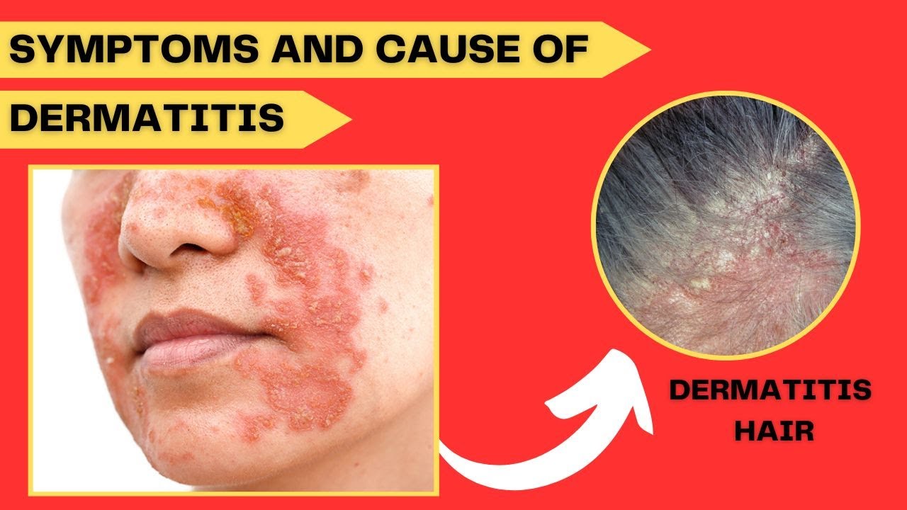 Symptoms and Cause of Dermatitis Disease - Causes - Sign - Your Doctor ...