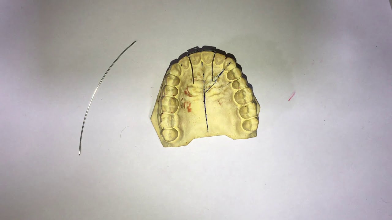 Fitted Labial Arch Figure - YouTube