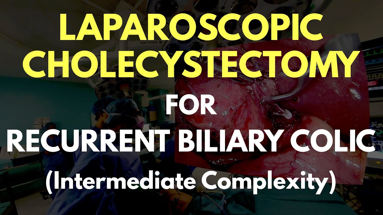 (FULL CASE) Laparoscopic Cholecystectomy for Recurrent Biliary Colic ...