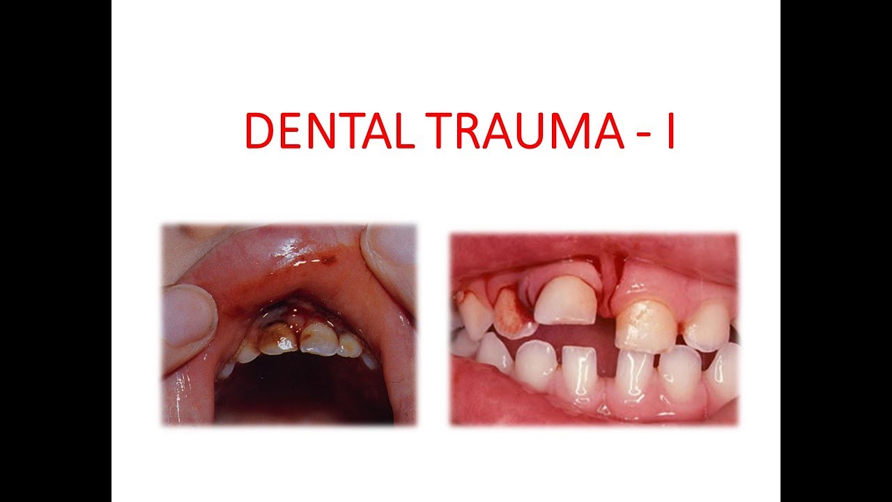 Dental Trauma I - YouTube