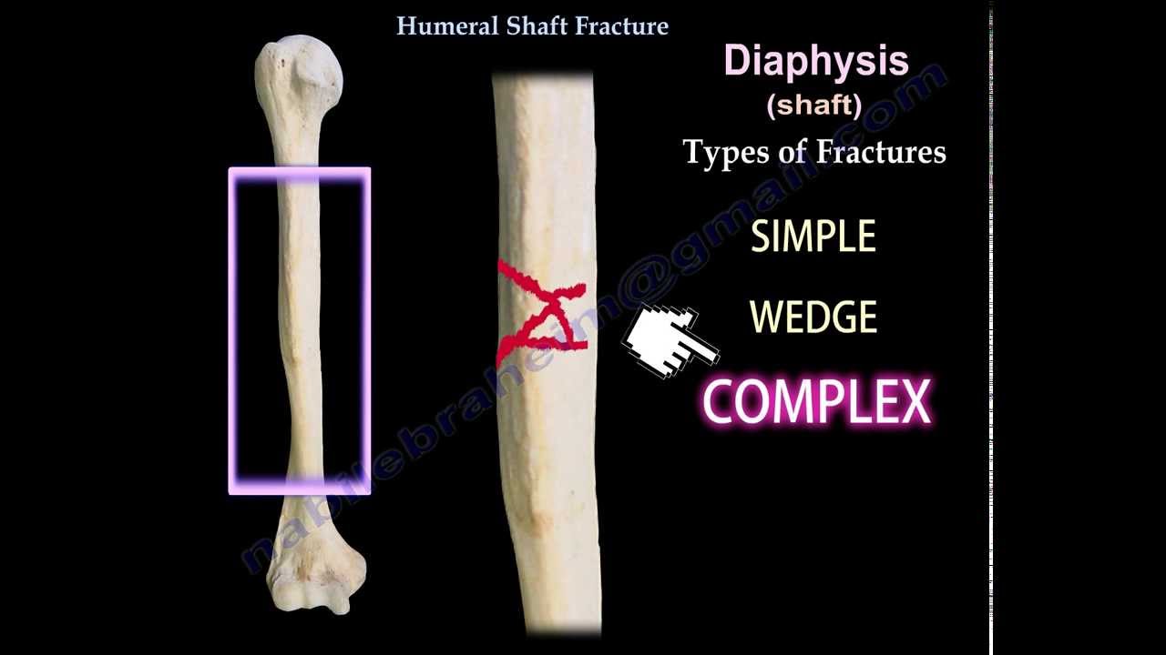 Humeral Shaft Fracture - Everything You Need To Know - Dr. Nabil ...