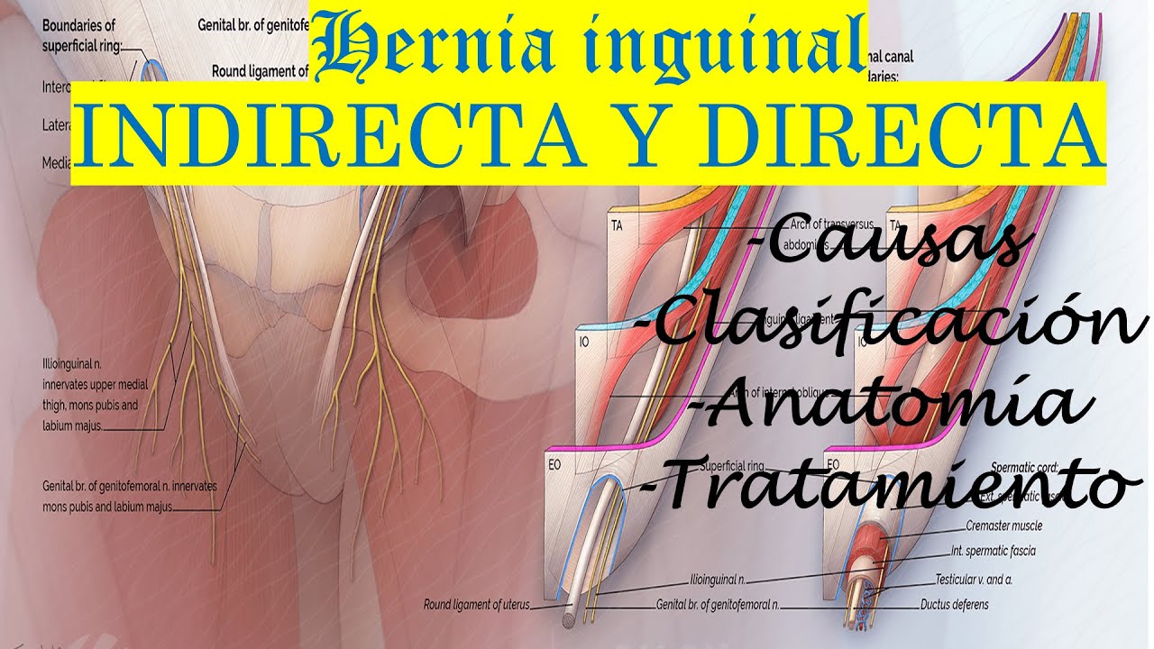 Hernia Inguinal Directa Vs. Indirecta: ¿Cuáles Son Las Diferencias? – KLHB