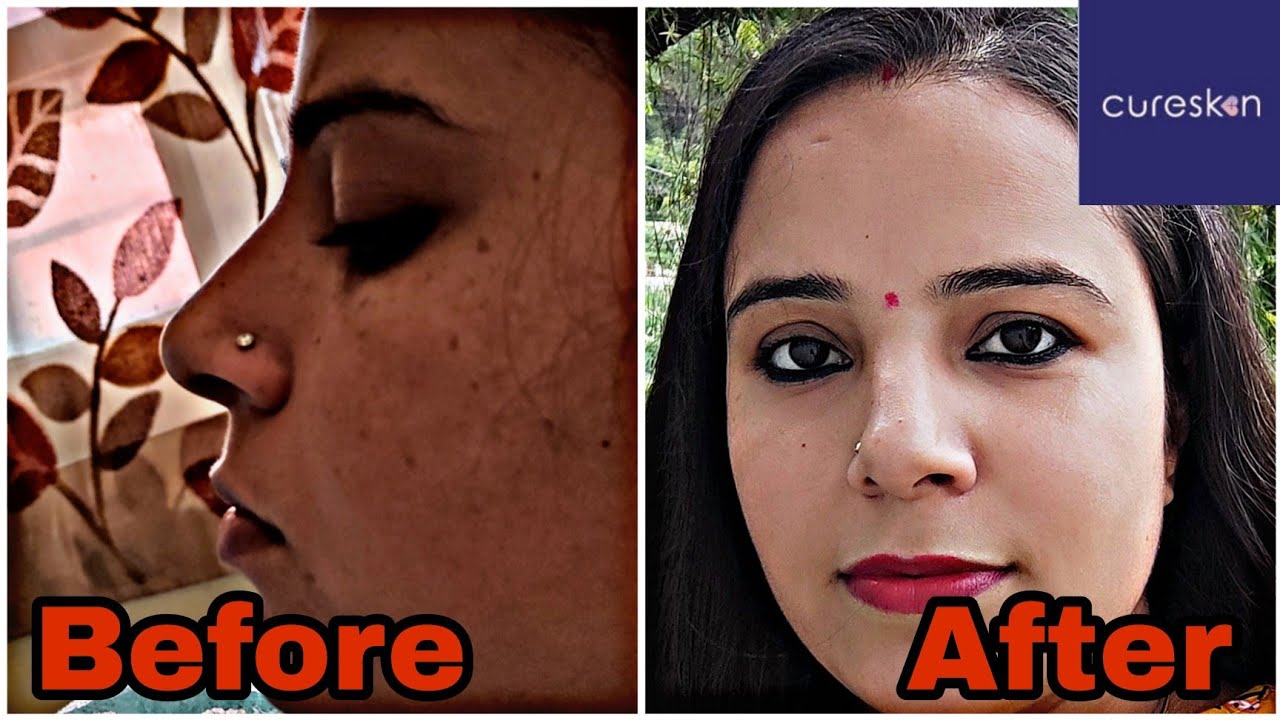 क्या ये सच में Effective है? Cure skin App Before & After || # ...