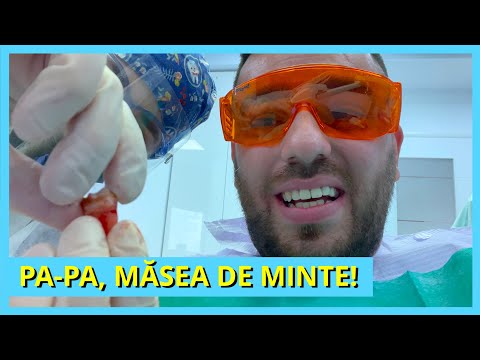 MI-AM SCOS O MĂSEA DE MINTE!  CUM A FOST EXTRACȚIA?