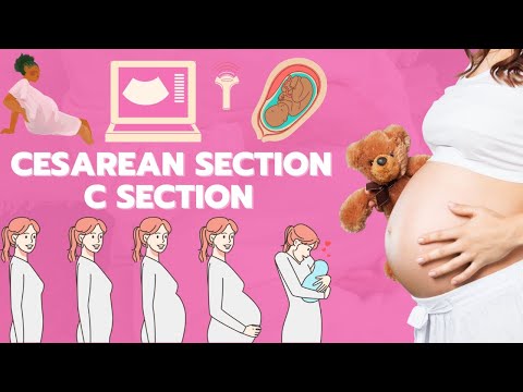 C-section animation | Cesarean section | Baby delivery animation