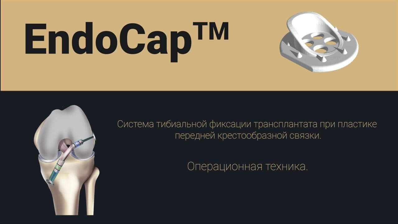 Система тибиальной фиксации трансплантата при пластике передней ...