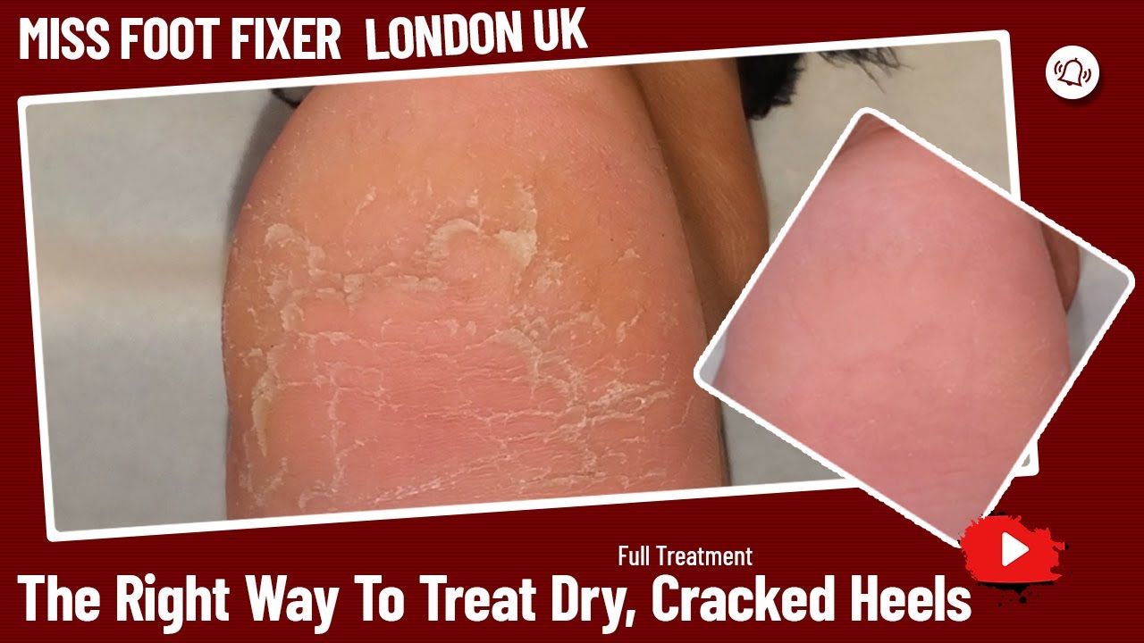 The Right Way To Treat Dry, Cracked Heels Full Treatment By Miss Foot ...