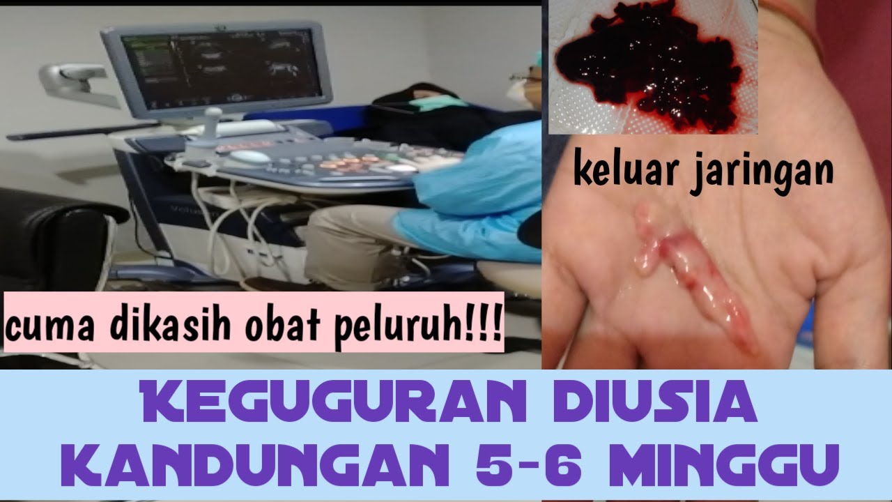 Keguguran diusia kehamilan 5-6 minggu - YouTube