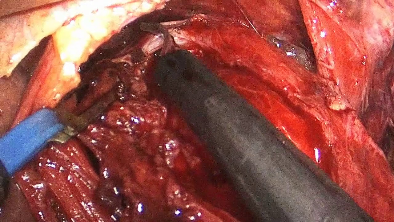 Heller myotomy post bypass - YouTube