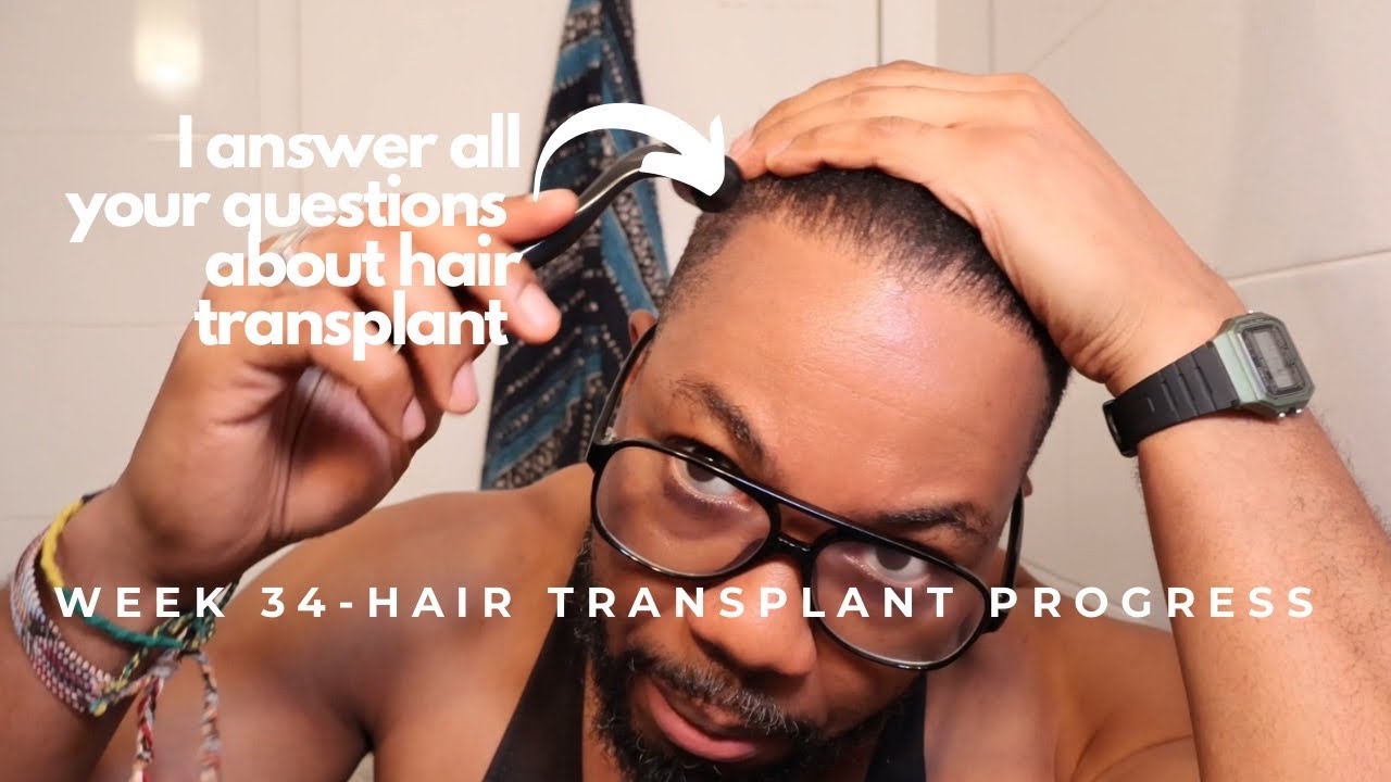 Week 34 - ( month 8 ) Turkey Hair transplant. I have all the answers to ...