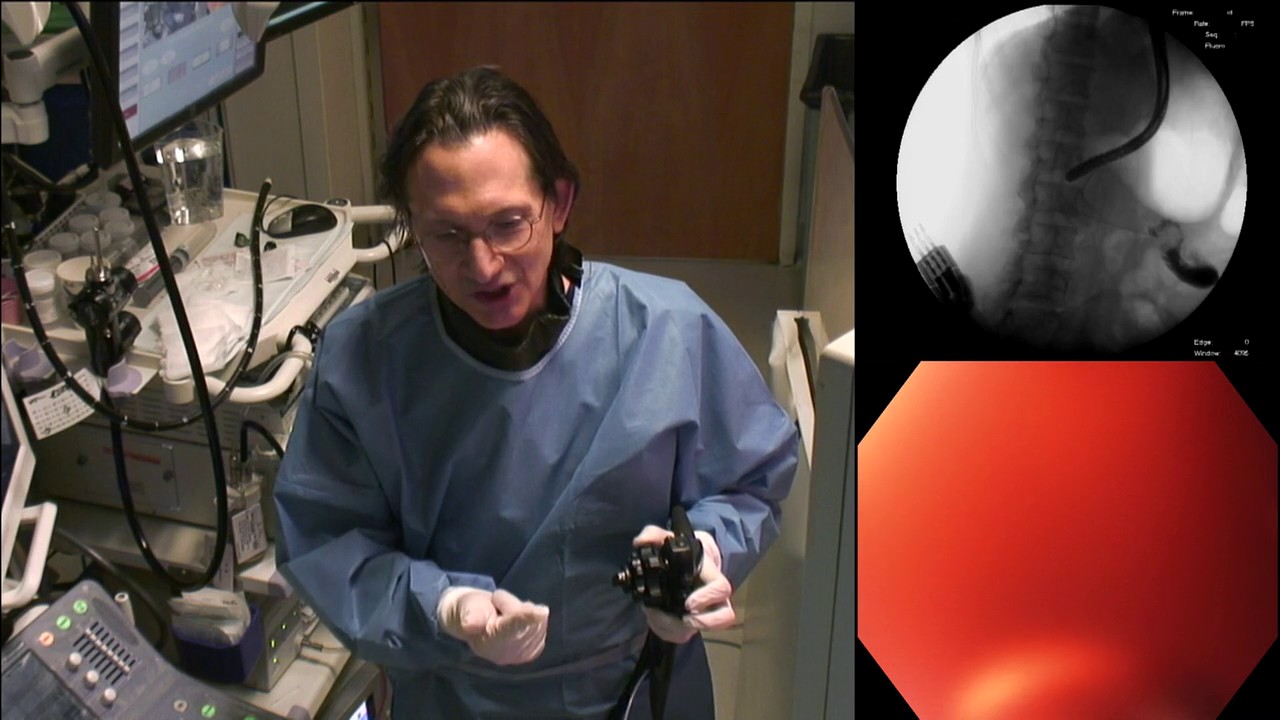 Gastrojejunostomy with Hot AXIOS HD - YouTube