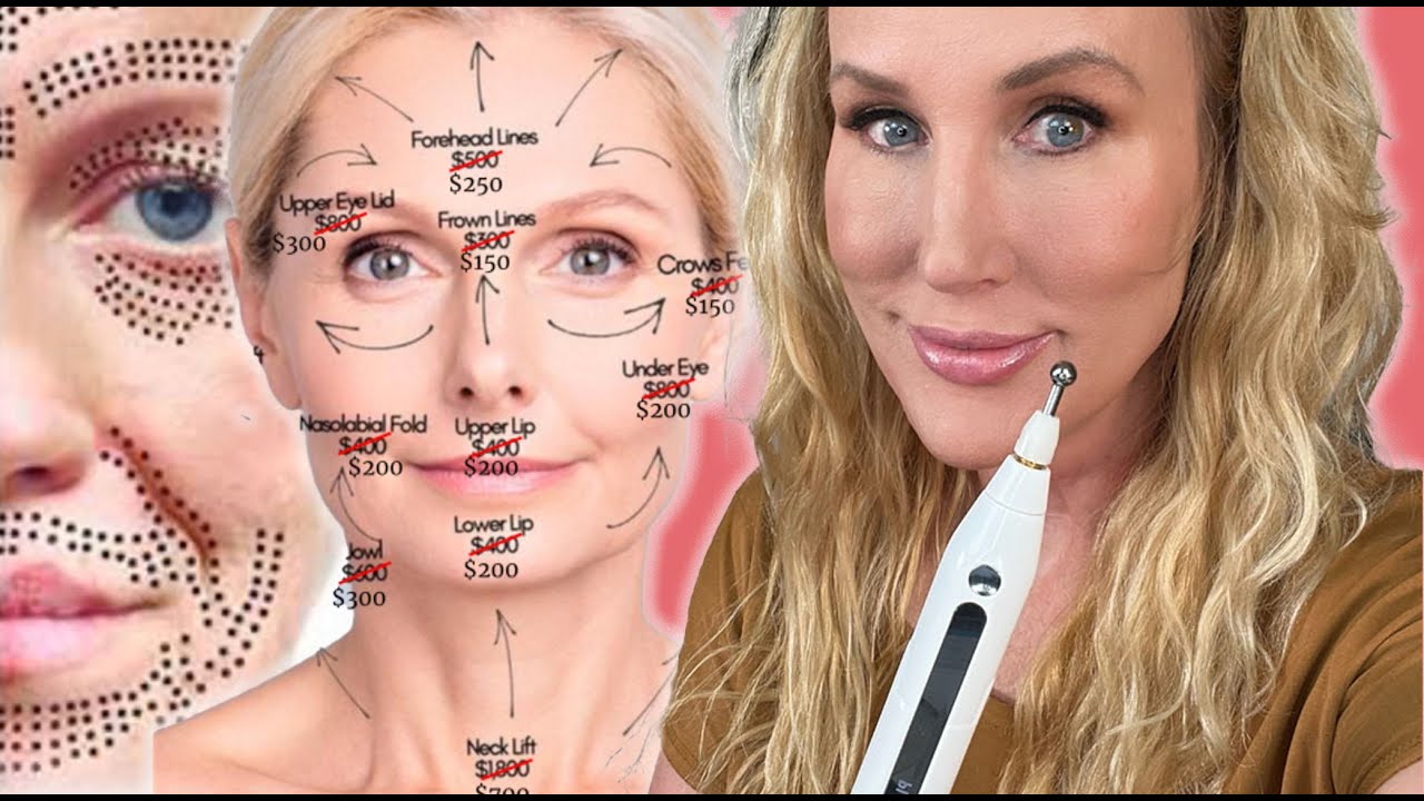 Plasma Pen Lifting Technique - No Downtime! #antiagingtreatments - YouTube