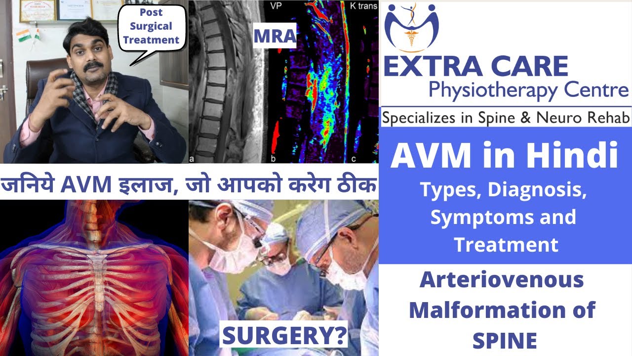 Arteriovenous Malformation of SPINE | Types, Diagnosis, Symptoms ...