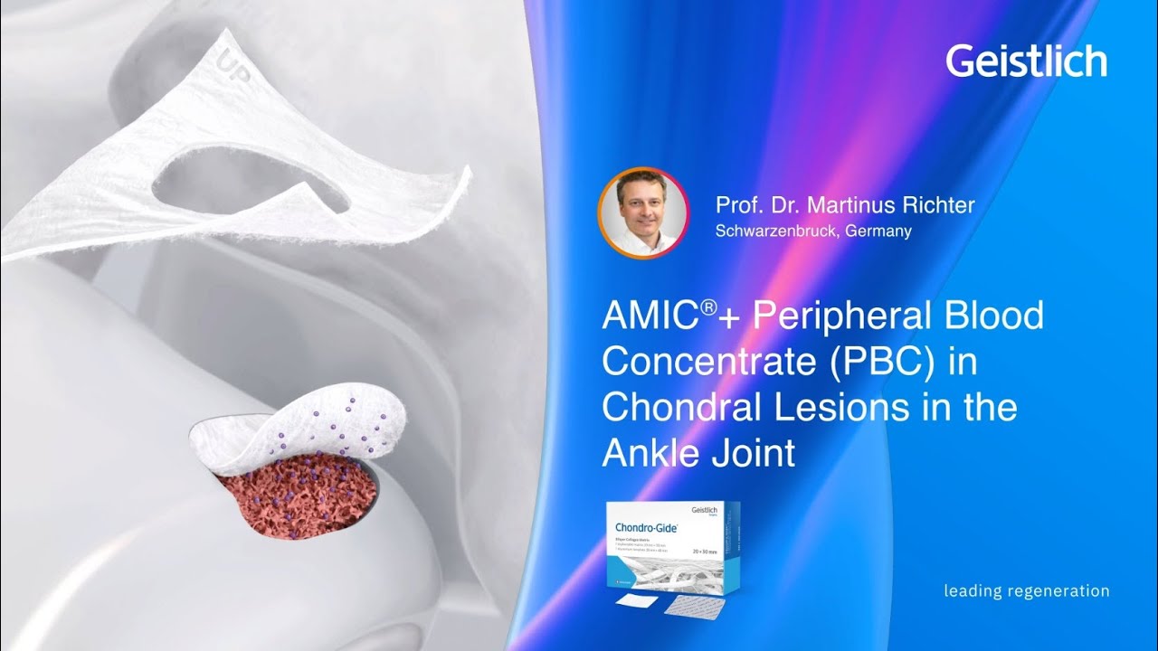 AMIC® + PBC in the ankle joint - Prof Martinus Richter - YouTube