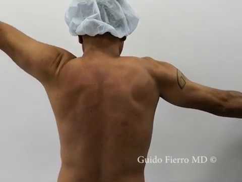 Triple Tendon Transfer (T3) for Trapezius Paralysis - English Version ...