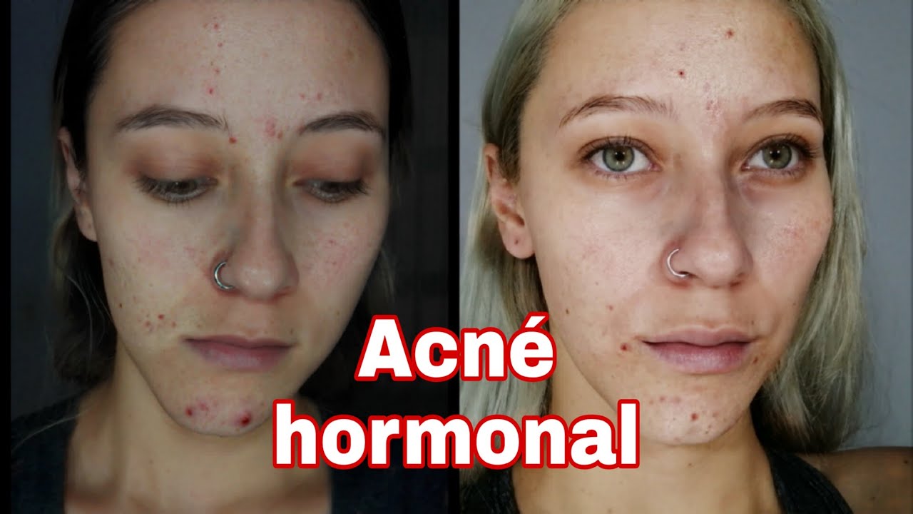ACNÉ HORMONAL - mi historia, diagnóstico, tratamiento, costo, tiempo ...