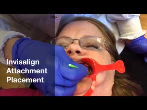Invisalign Attachment Placement - YouTube