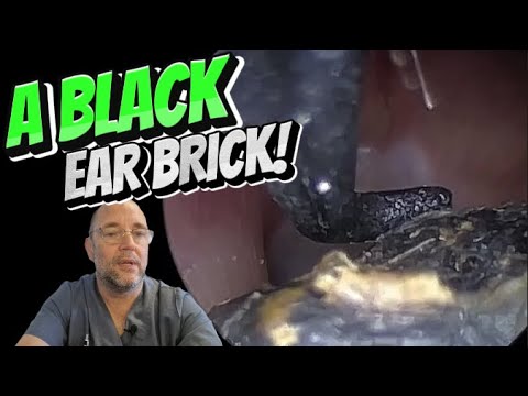 A BLACK EAR BRICK! 309 #ear #earwax #earwaxremoval #earcleaning #foryou ...